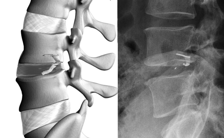 Barricaid Surgery - UOA - University Orthopaedic Associates